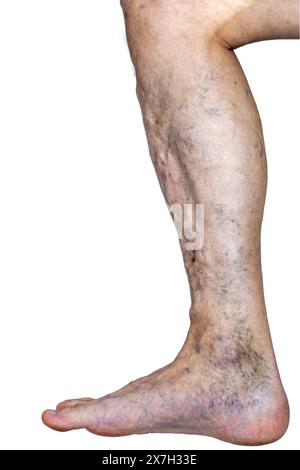 Thrombophlebitis. Deep Vein Thrombosis. Varicose veins. Phlebeurysm ...