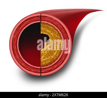 Formation of blood clot in a vessel obstructs the artery or vein and ...