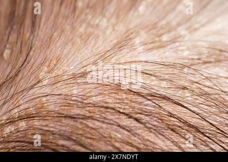 Newborn baby with psoriasis or dandruff in the hair Stock Photo - Alamy