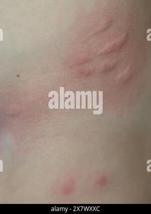 Red, swollen and itchy spots on skin caused by insect bites or allergy ...