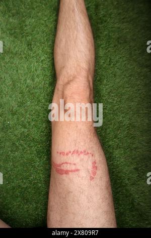 A jellyfish sting burn on a man's leg Stock Photo - Alamy