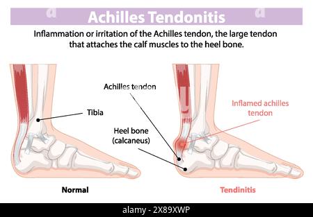 Comparison of normal and inflamed Achilles tendon Stock Vector Image ...