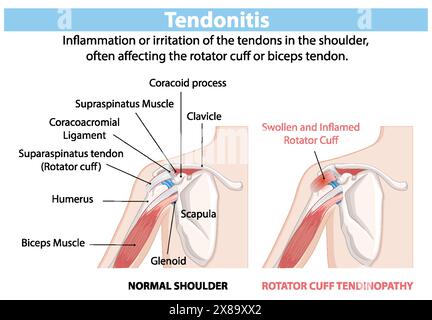 Illustration of normal and inflamed shoulder tendons Stock Vector Image ...