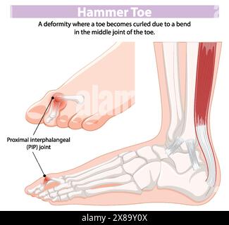 Diagram showing hammer toe deformity and anatomy Stock Vector Image ...