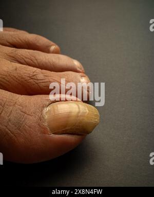 photo of foot with long thumb toe nail Stock Photo - Alamy