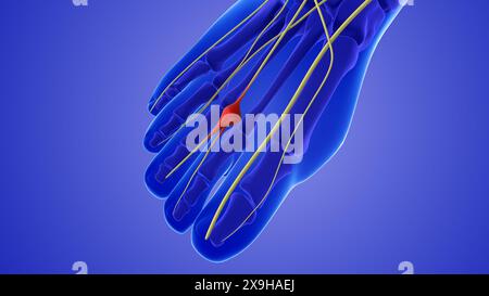 Pinched nerve or neuroma medical animation Stock Photo - Alamy