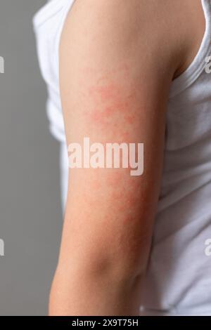 Child's arm with red rash Stock Photo - Alamy
