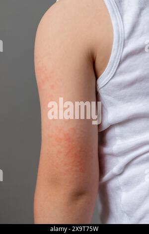 Child's arm with red rash Stock Photo - Alamy