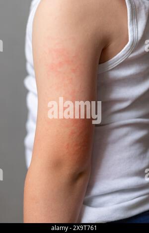 Child's arm with red rash Stock Photo - Alamy