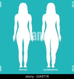 Lymphedema Silhouette Illustration with Woman with Normal and Lipedema ...