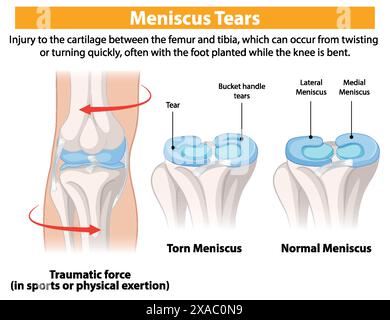 Illustration of normal and torn meniscus in knees Stock Vector Image ...