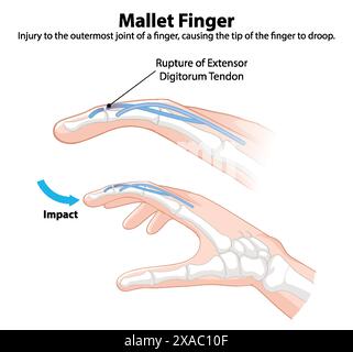 Diagram showing mallet finger injury and tendon rupture Stock Vector ...