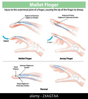 Diagram showing mallet finger injury details Stock Vector Image & Art ...