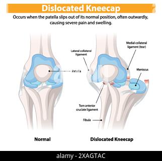 Comparison of normal and dislocated kneecap Stock Vector Image & Art ...
