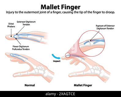 Diagram showing normal and mallet finger conditions Stock Vector Image ...