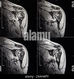 MRI image of the shoulder joint after a fracture and dislocation ...