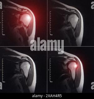 MRI image of the shoulder joint after a fracture and dislocation ...
