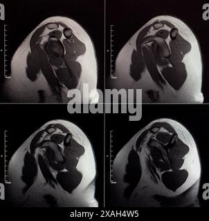 MRI image of the shoulder joint after a fracture and dislocation ...