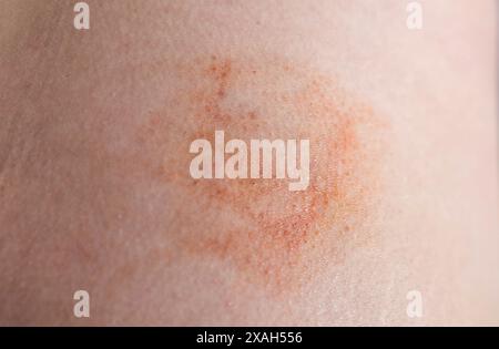 Bruise and subcutaneous lump on the patient s skin after injections ...
