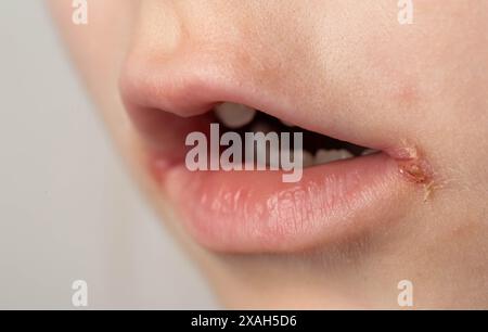 Pain and itching in the corners of the lips of a girl's mouth. Seizures ...