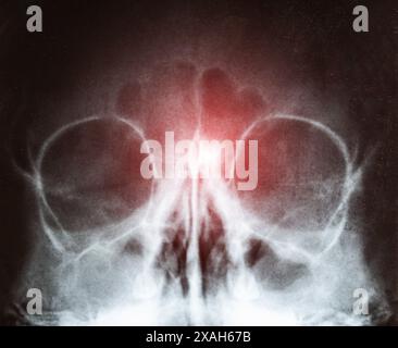 X-ray of sinusitis in a child. Inflammation of the nasal sinuses with ...