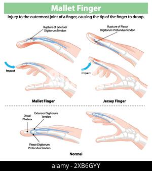 Diagram showing mallet finger injury and tendon rupture Stock Vector ...