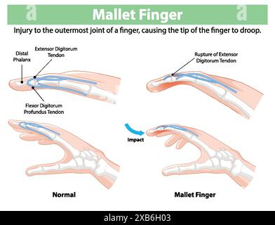 Diagram showing normal and mallet finger conditions Stock Vector Image ...