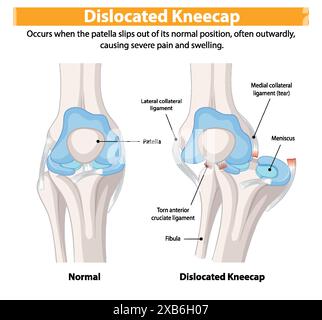 Comparison of normal and dislocated kneecap Stock Vector Image & Art ...
