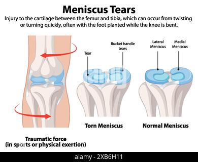 Illustration of knee anatomy and meniscus tears Stock Vector Image ...