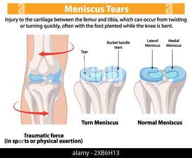 Meniscal tear. Torn meniscus. Knee injury. Cartilage damage. Meniscal ...