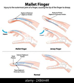 Diagram showing mallet finger injury and tendon rupture Stock Vector ...