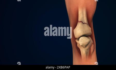 Leg bone Fracture or inflammation of human knee cap Stock Photo - Alamy