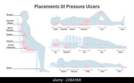 Medical illustration of the stages of the decubitus ulcer, with ...