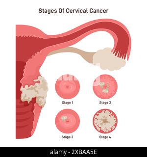 Cervical cancer. Carcinoma. Malignant neoplasm arising from cells in ...