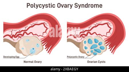 Ovarian cyst diagram Female reproductive system uterus labeled in Anatomical infographic. Front ...