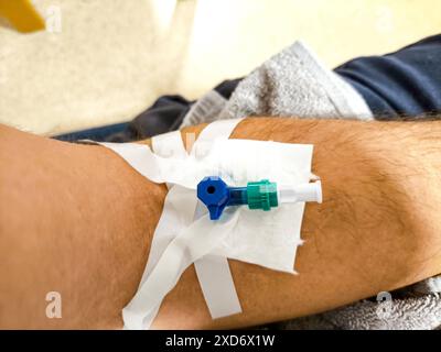 Germany - June 20, 2024: Arm, with intravenous cannula Venflon in place ...