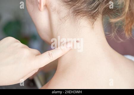 Woman examing her abnormal mole. Dermatology procedure. Doctor checking ...
