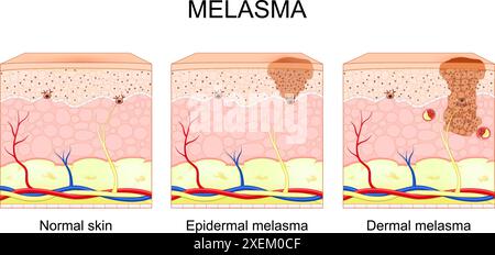 Skin pigmentation. Cross section of a human Epidermis with Melanocytes ...