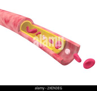 Anatomical 3d illustration of incompetent vein and varicose veins in ...