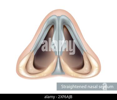 Deviated Nasal Septum. Nose, nasal cavity. Inferior view Stock Vector ...