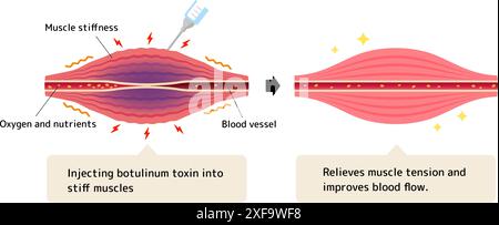 Mechanism of muscle relaxation by botulinum toxin injection Stock ...
