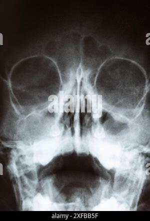 Close-up of the red and inflamed nose of a 38 year old female patient ...