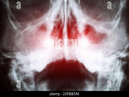 Close-up of the red and inflamed nose of a 38 year old female patient ...