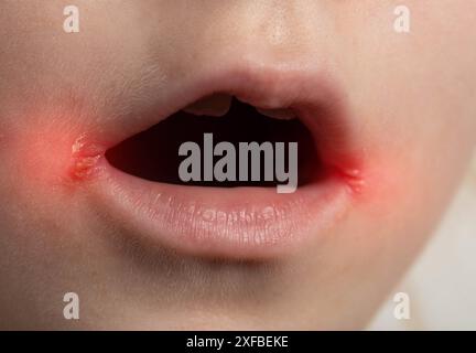 Angular cheilitis, an infectious disease of the corner of the lips ...