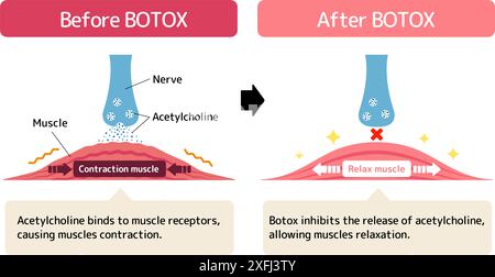 Mechanism of muscle relaxation by Botox. Vector illustration Stock ...