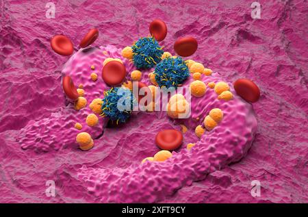 Basal-cell carcinoma (BCC) - isometric view 3d illustration Stock Photo ...