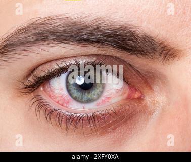 Close-up of irritated red eye with visible blood vessels and crusting ...