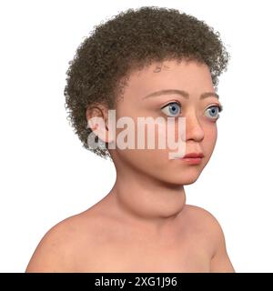Illustration of a child with Graves' disease, causing an enlarged ...
