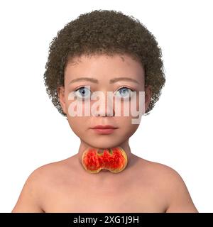 Illustration of a child with Graves' disease, causing an enlarged ...
