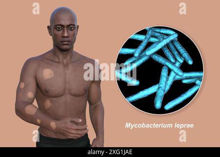 Illustration of a man with hypopigmented lesions on his arm and trunk ...